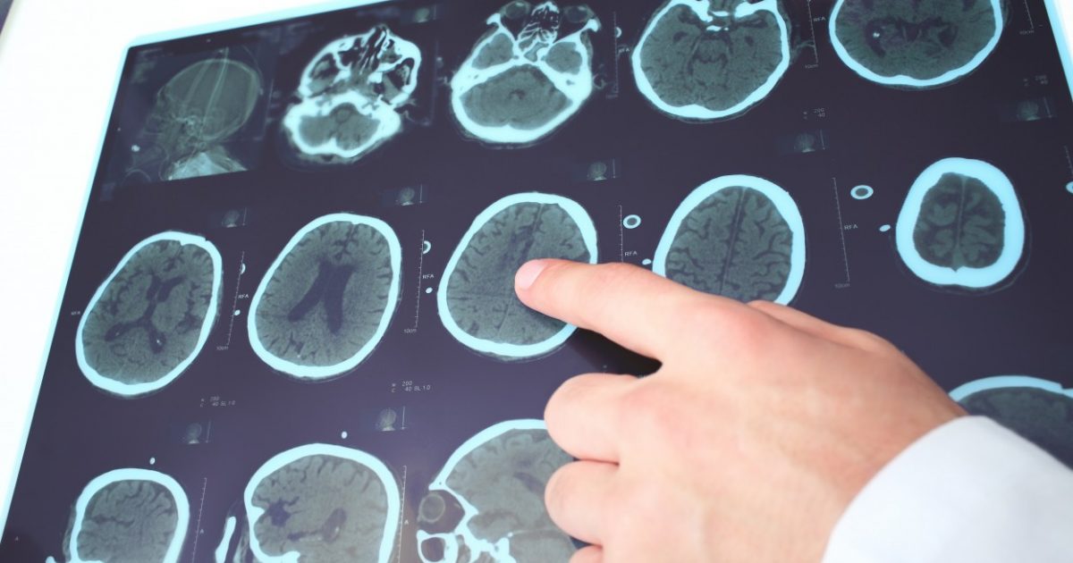 Study Examines Brain Lesion Neuroimaging for Young Fabry Disease Patients